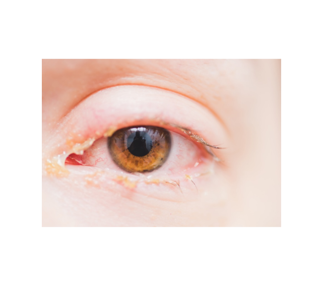 Conjunctivitis - ABDO
