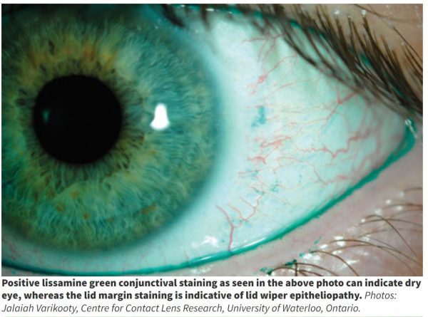 Focus on ... DED assessment - ABDO